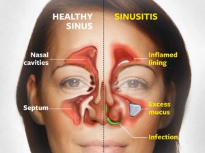 Propel Implants For Chronic Sinusitis - Pacific Eye & Ear Specialists