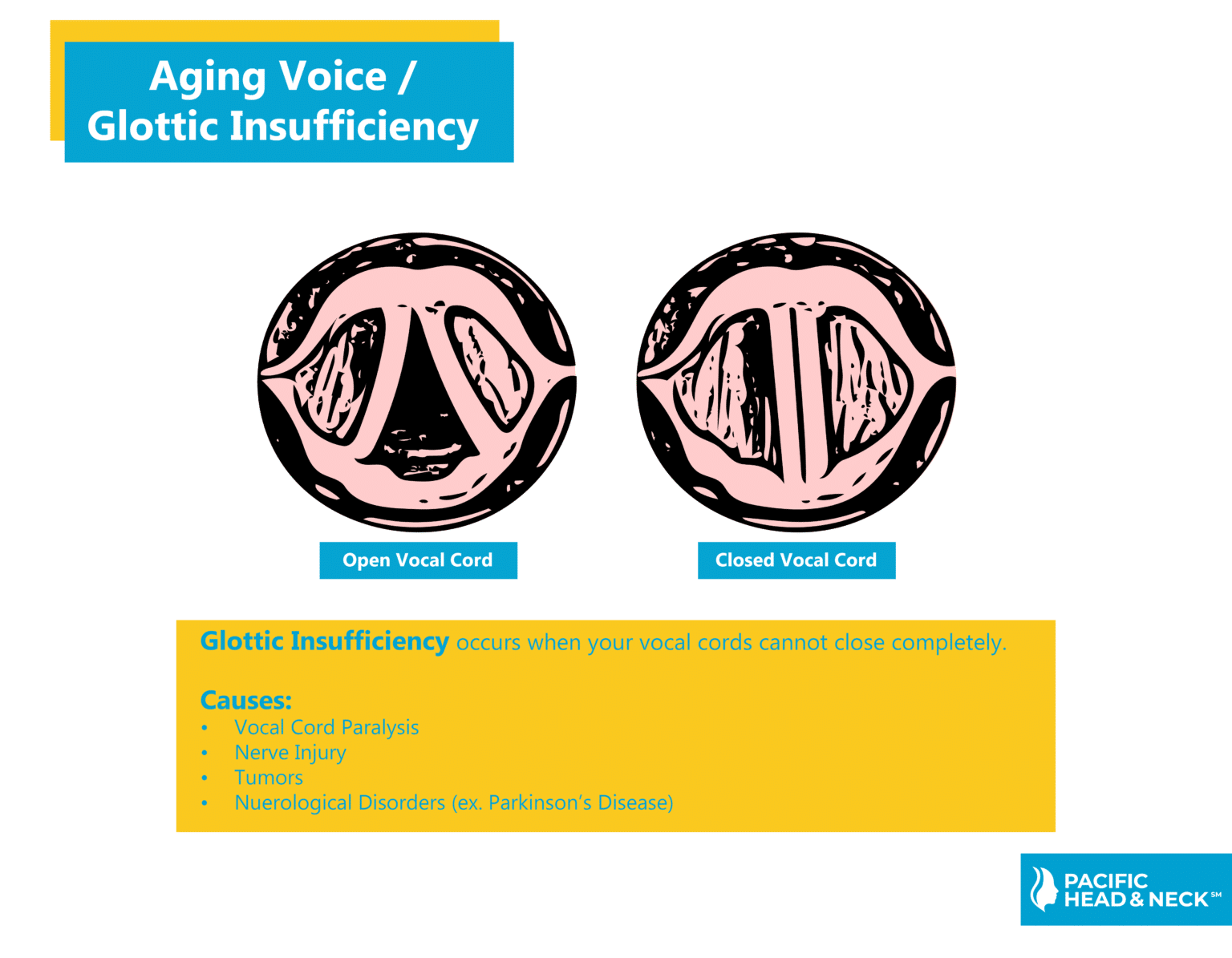 Aging Voice / Glottic Insufficiency - Pacific Head & Neck