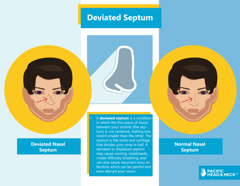 Deviated Septum (Septoplasty) - Pacific Head & Neck
