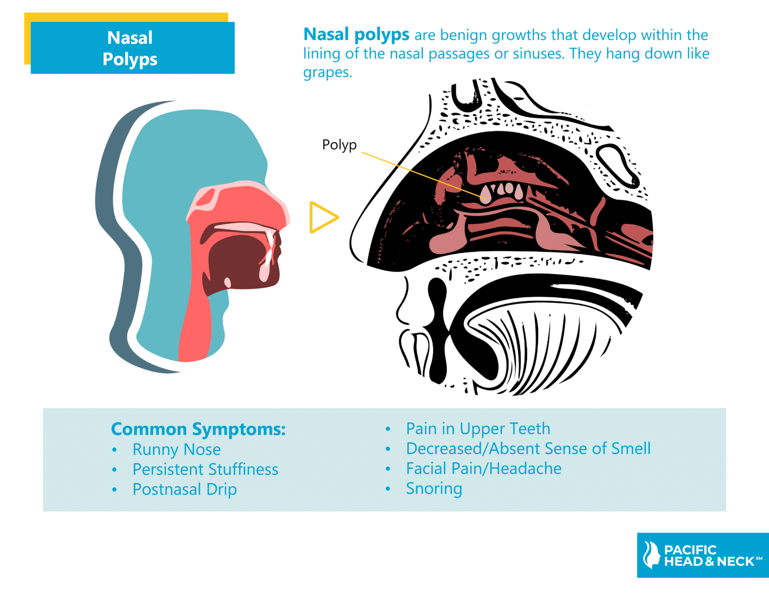 Case Study: Chronic Sinusitis with Nasal Polyposis - Pacific Head and Neck