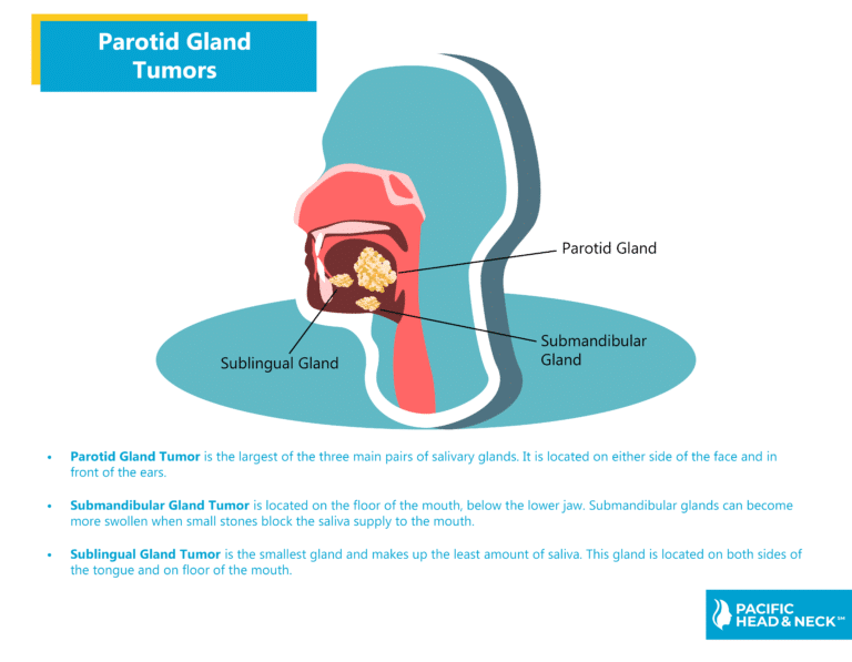 Parotid & Gland Tumors - Pacific Head & Neck