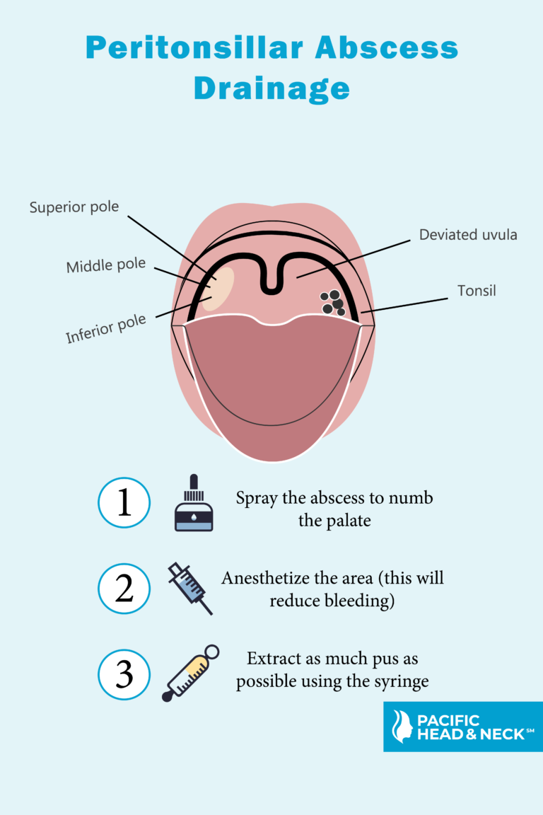 Peritonsillar Abscess - Pacific Eye & Ear Specialists
