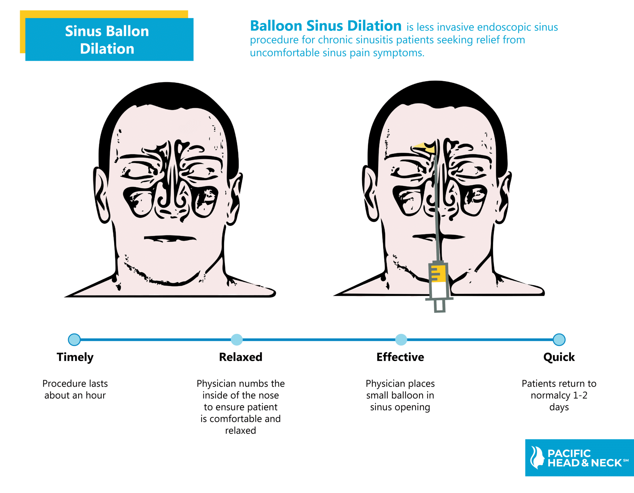 In-Office Balloon Sinuplasty - Pacific Eye & Ear Specialists