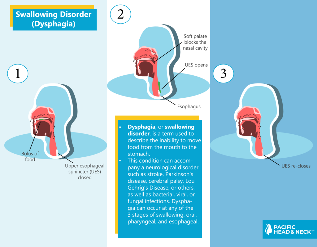 Swallowing Disorders - Pacific Eye & Ear Specialists