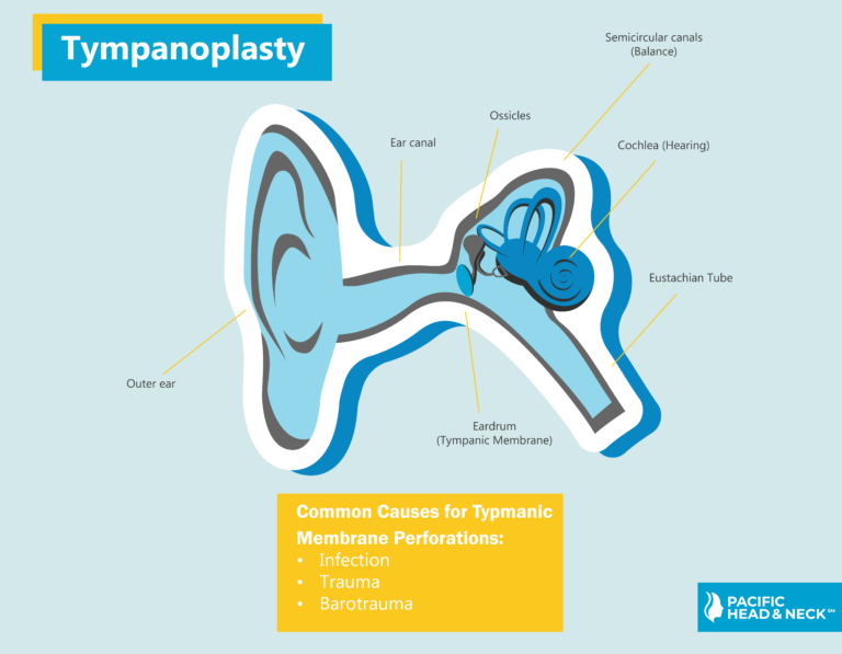Tympanoplasty (Repair of Eardrum) - Pacific Head & Neck