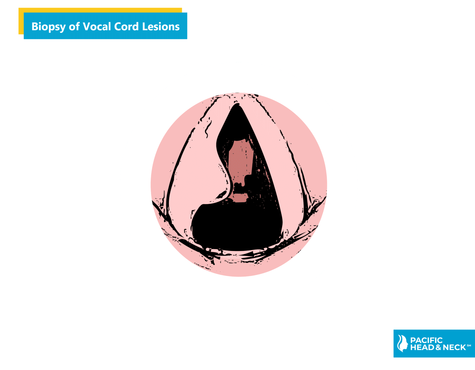 Biopsy of Vocal Cord Lesions - Pacific Head & Neck