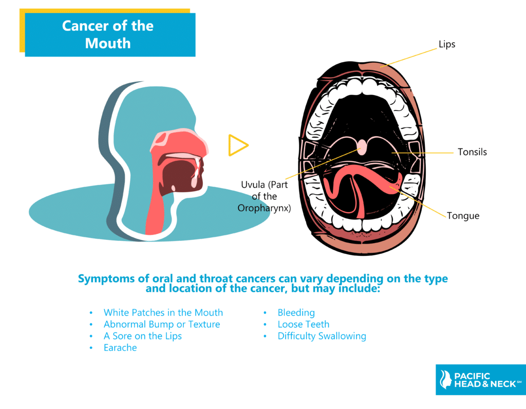 Cancer of the Mouth & Throat - Pacific Head and Neck