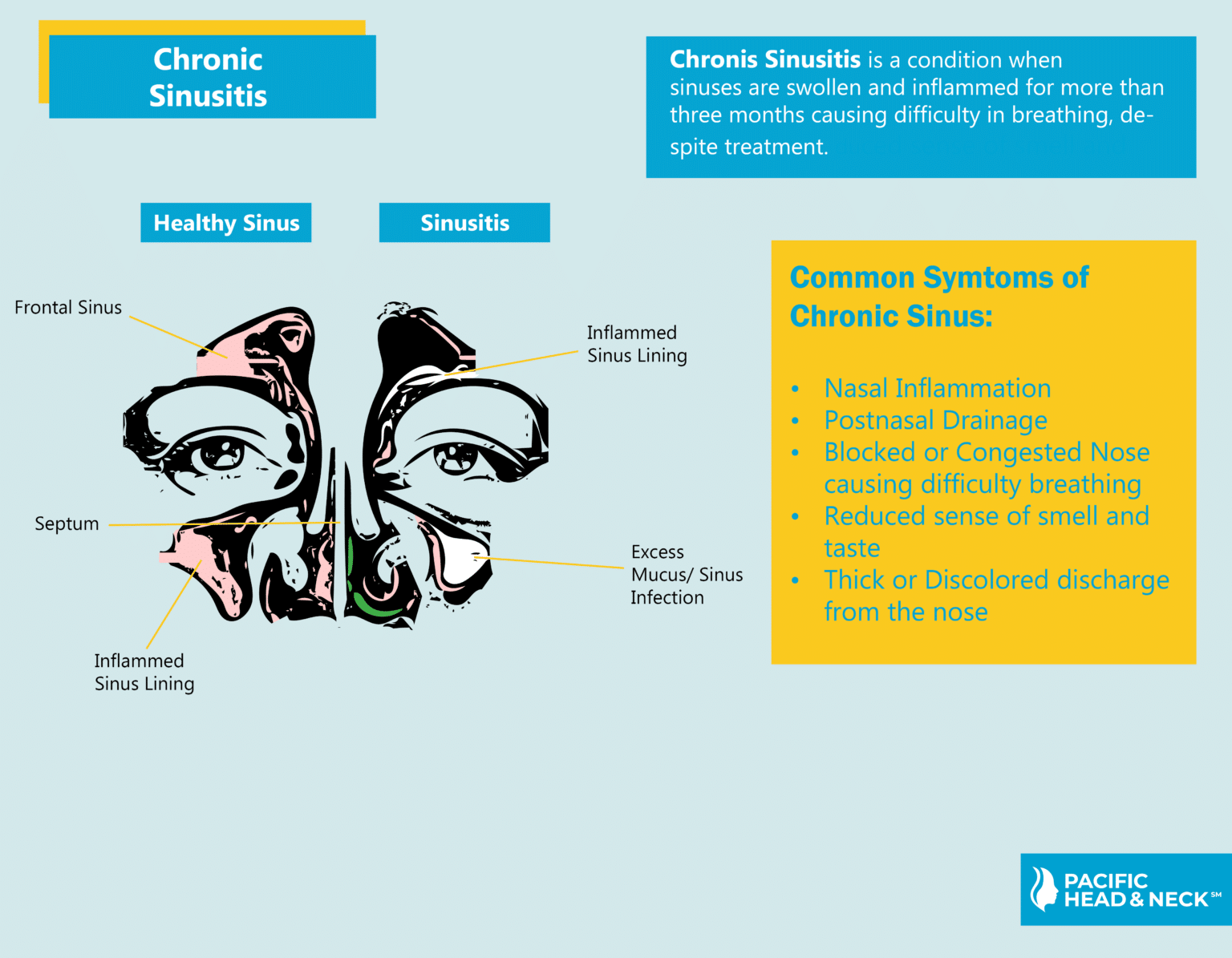 Chronic Sinusitis - Pacific Head & Neck