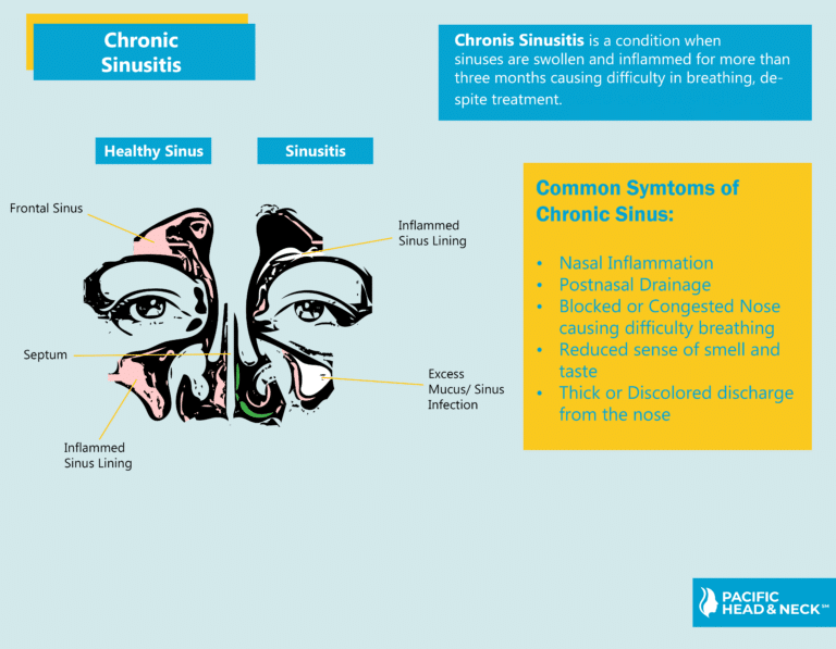 Chronic Sinusitis - Pacific Head & Neck