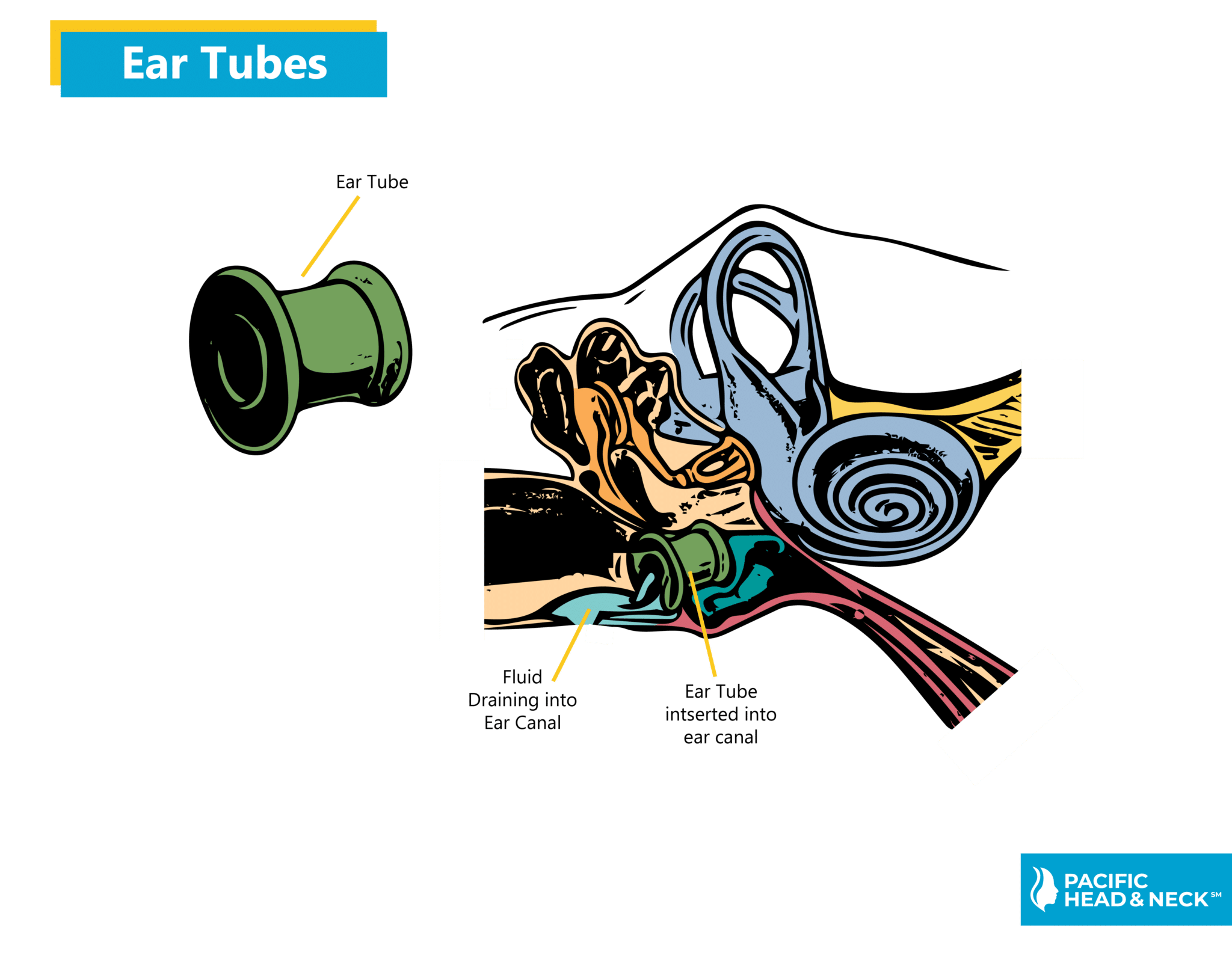 Ear Tubes - Pacific Head & Neck