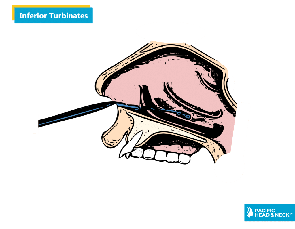 Radiofrequency Treatment of Inferior Turbinates - Pacific Eye & Ear ...