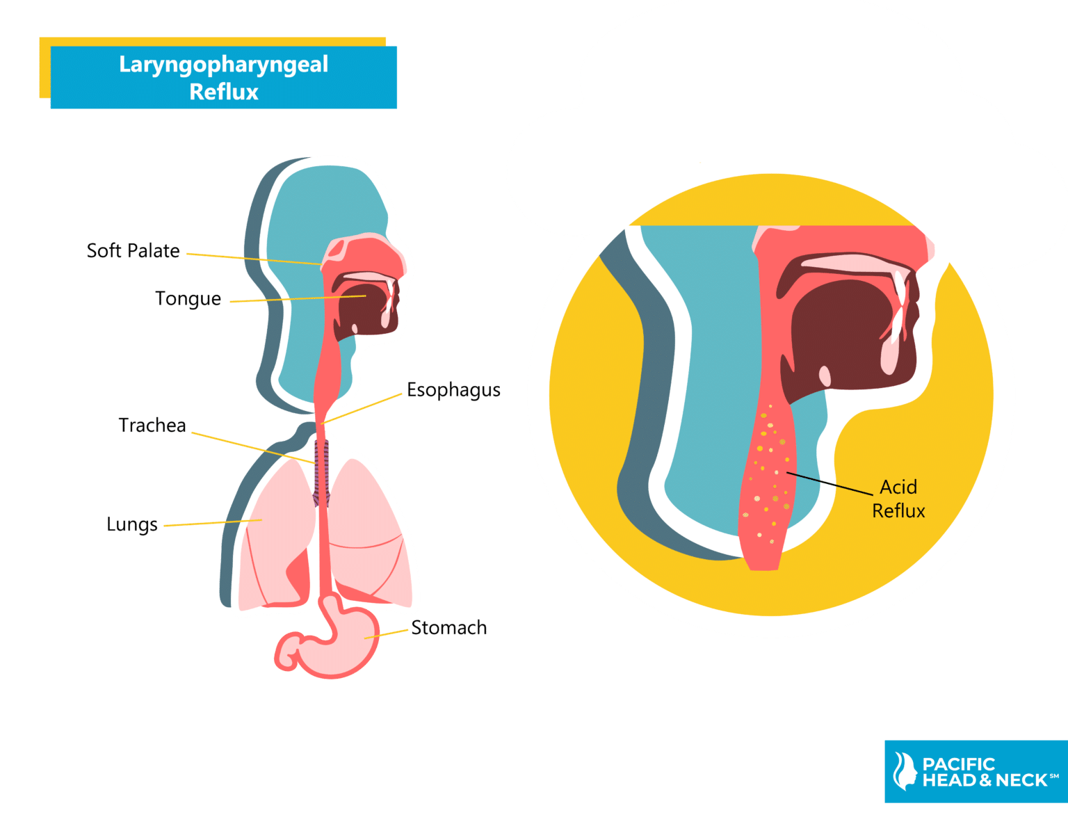 Laryngopharyngeal Reflux (Acid Reflux) - Pacific Head & Neck