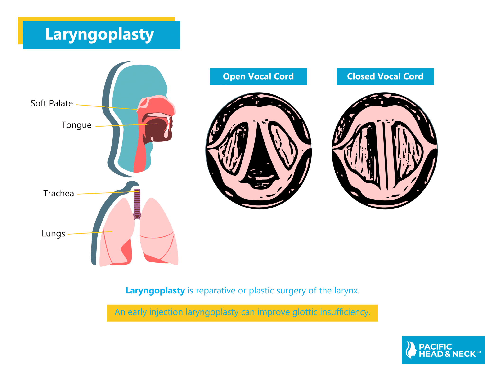 Acute & Chronic Hoarseness - Pacific Head & Neck