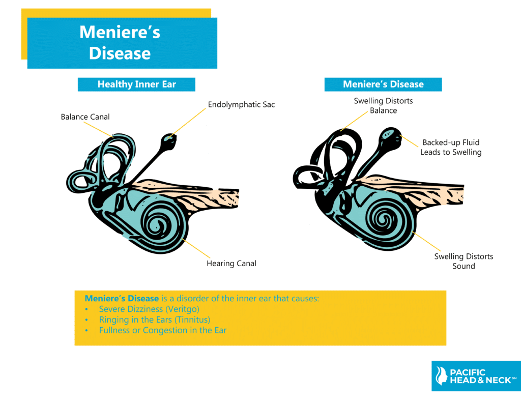 Meniere's Disease - Pacific Head & Neck