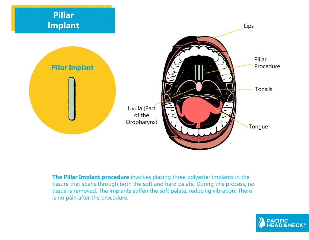Pillar Implants - Snoring & Sleep Apnea - Pacific Head & Neck