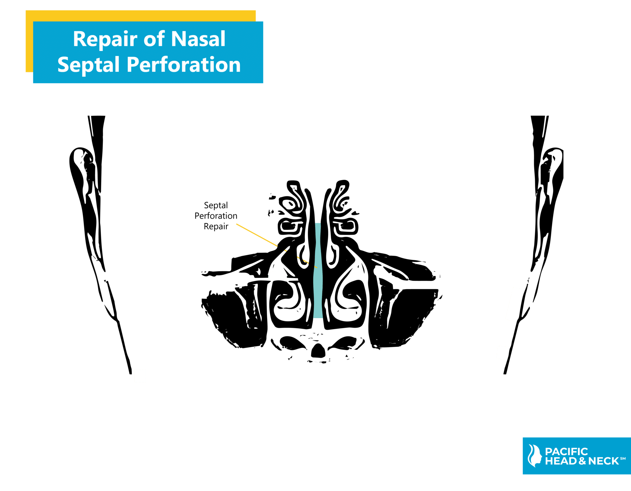 Repair Septal Perforations - Pacific Eye & Ear Specialists