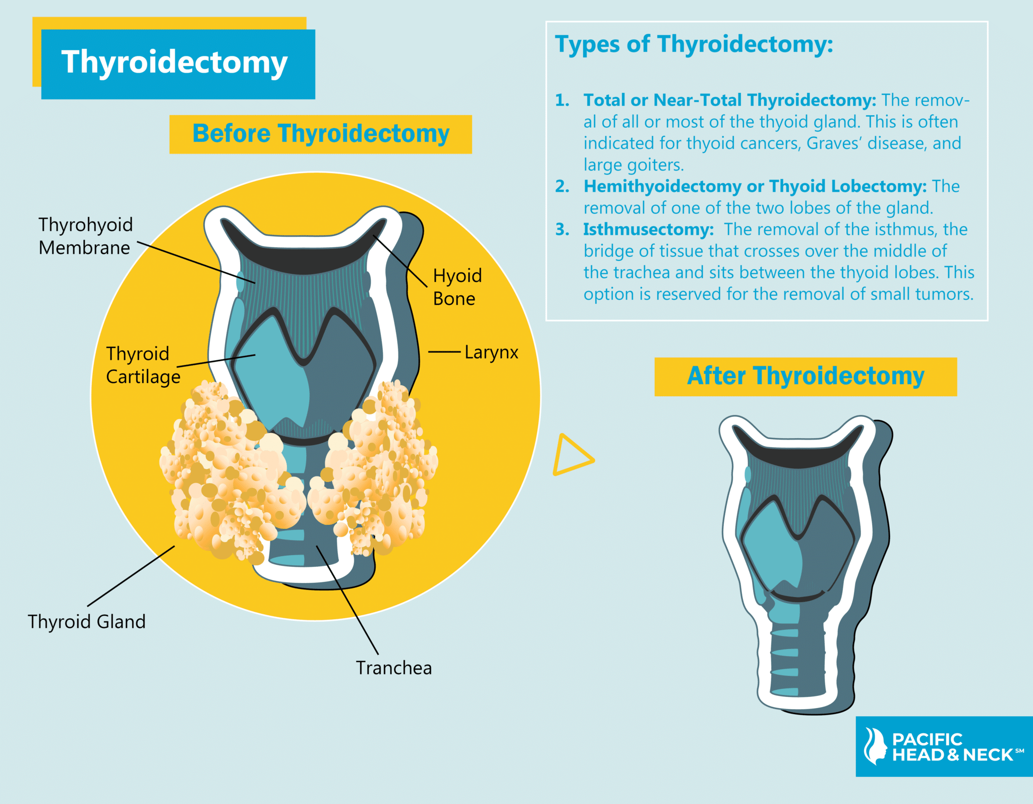Thyroidectomy - Pacific Eye & Ear Specialists