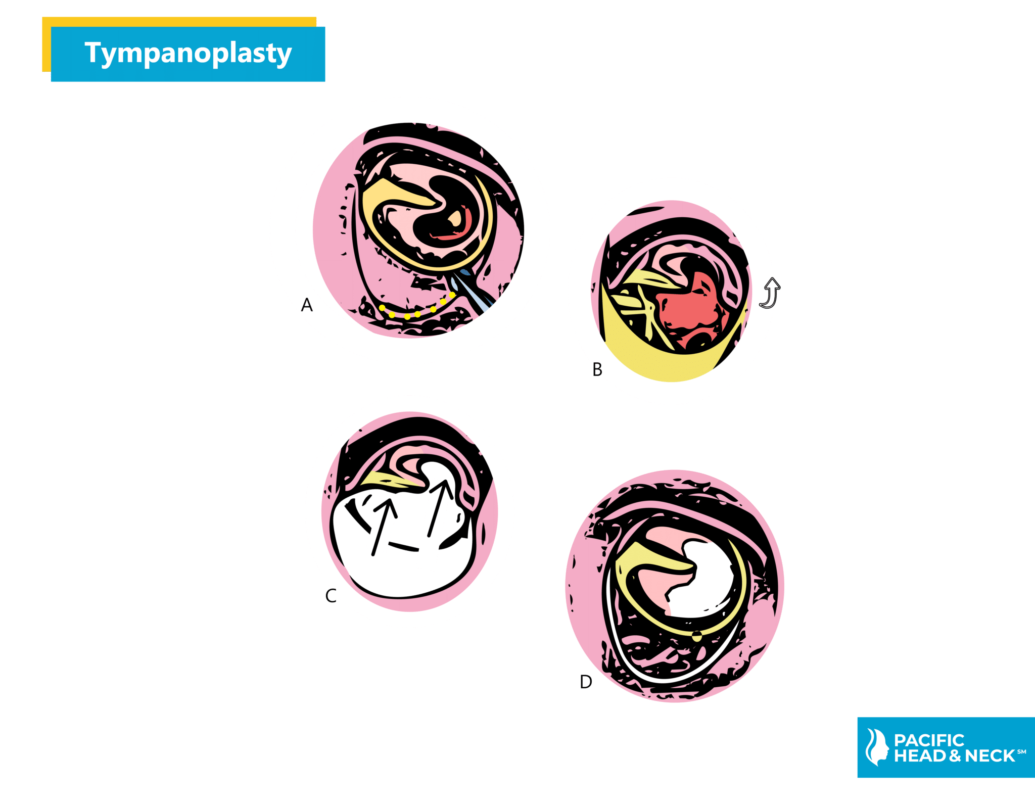 Tympanoplasty (Repair of Eardrum) - Pacific Head & Neck