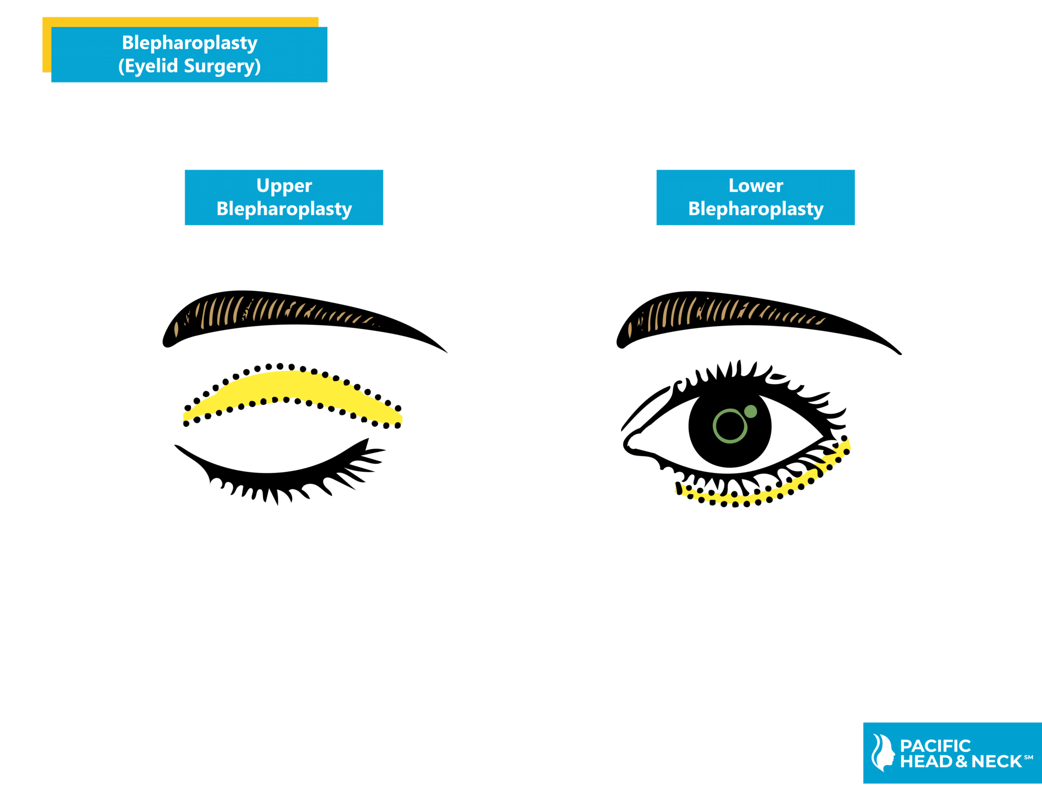 Blepharoplasty (Eyelid Surgery) - Pacific Head and Neck