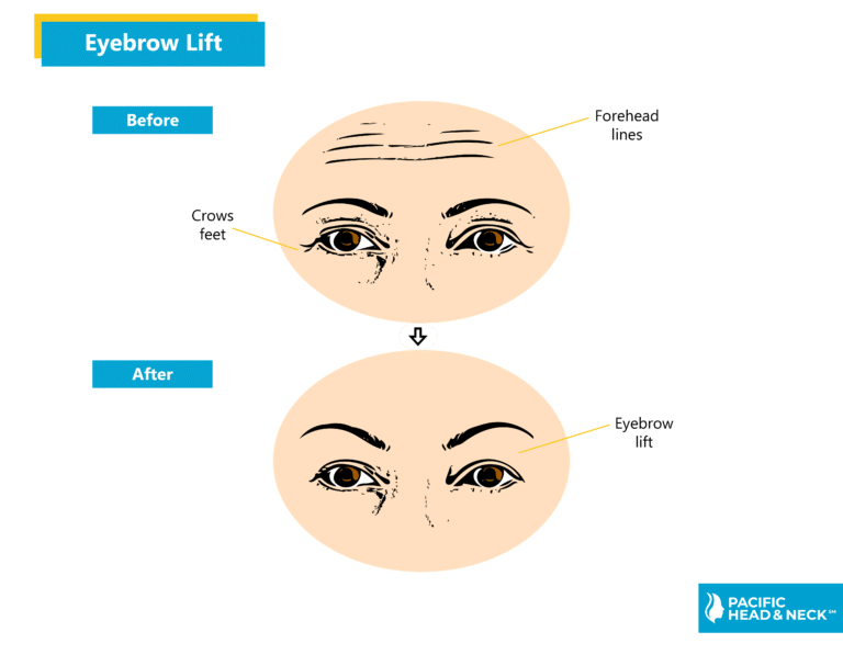 Eyebrow Lift - Pacific Head and Neck