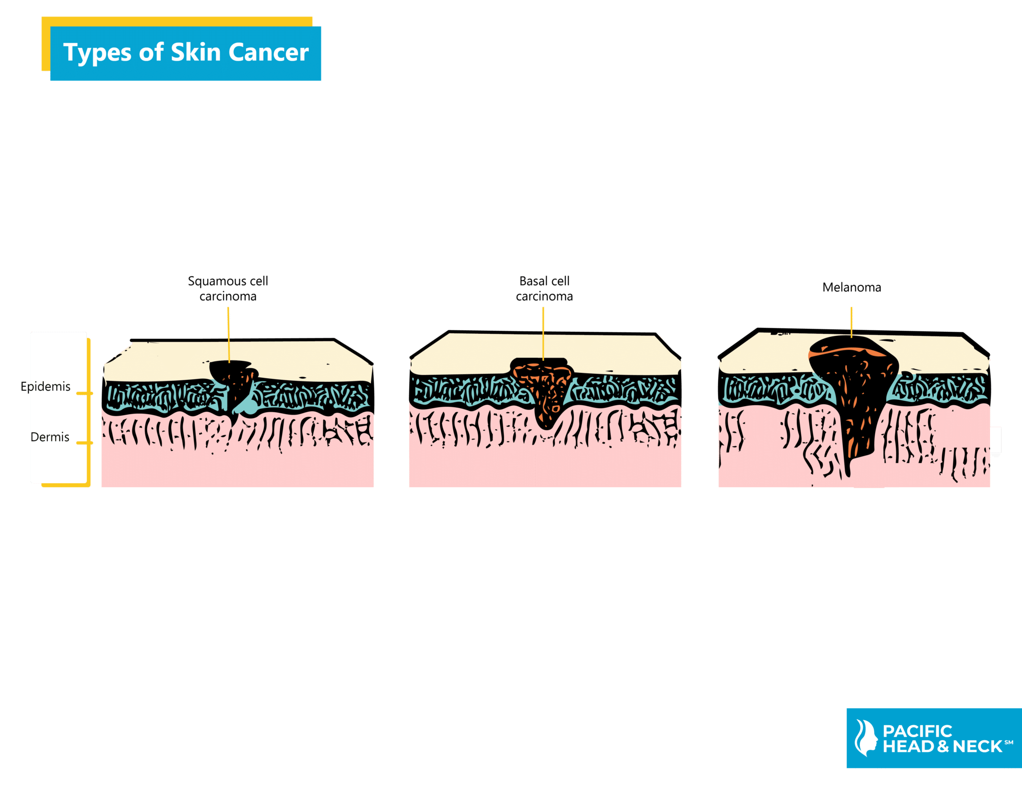 Repair of Skin Cancer Excisions (MOHS) - Pacific Head & Neck