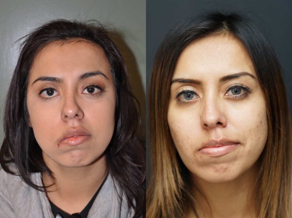 Case Presentation - Facial Paralysis - Pacific Head and Neck