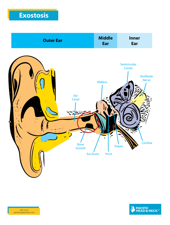 Surfer's Ear (Exostosis) - Pacific Head & Neck