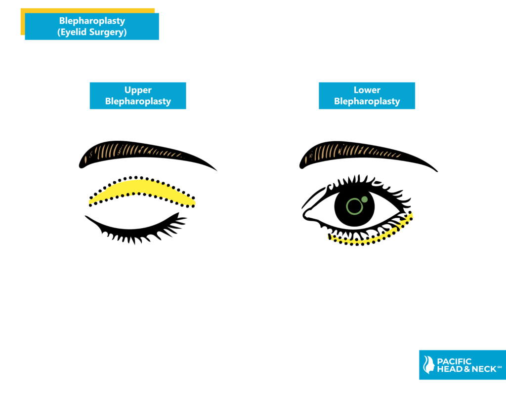 Blepharoplasty (Eyelid Surgery) - Pacific Head and Neck