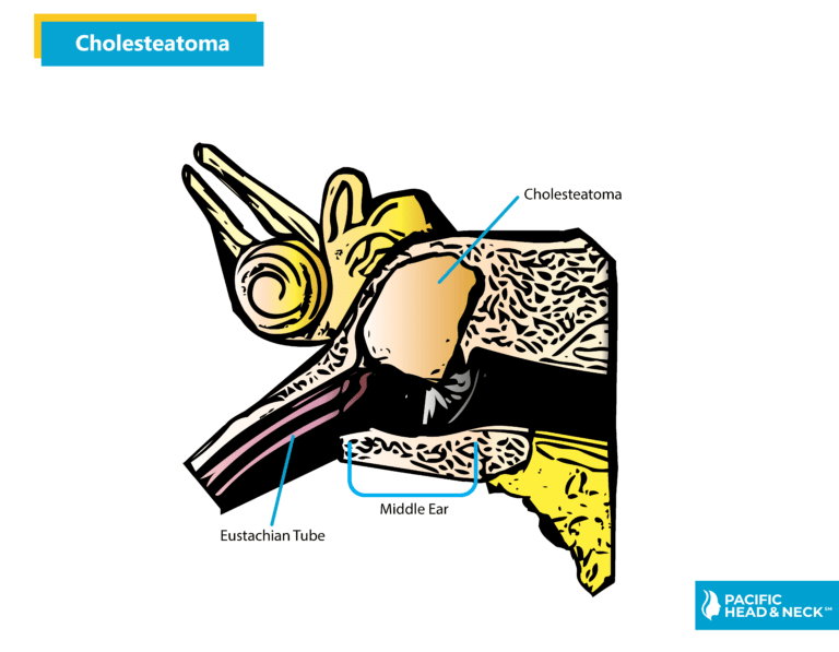 Cholesteatoma - Pacific Head and Neck